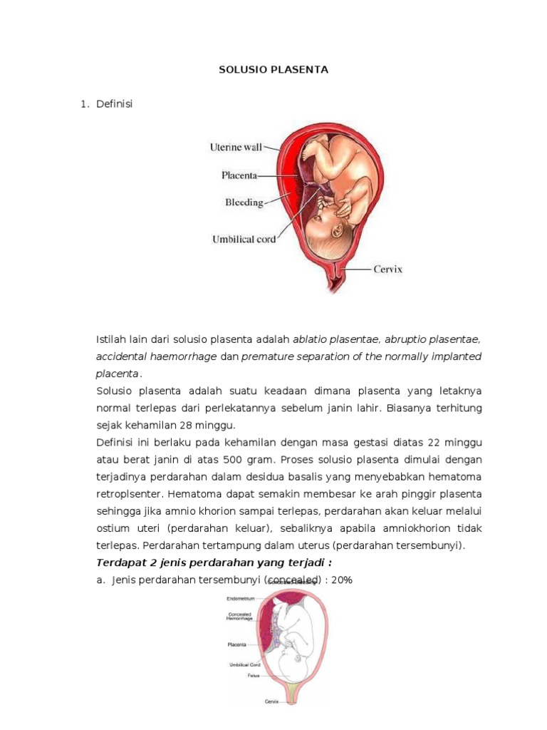 Solusio Plasenta | PDF
