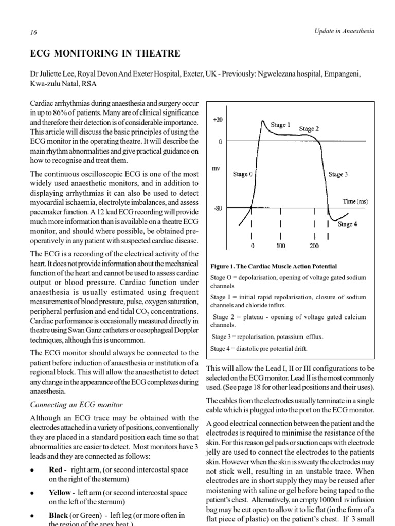 ECG Monitoring in Theatre | PDF | Cardiac Arrhythmia | Electrocardiography
