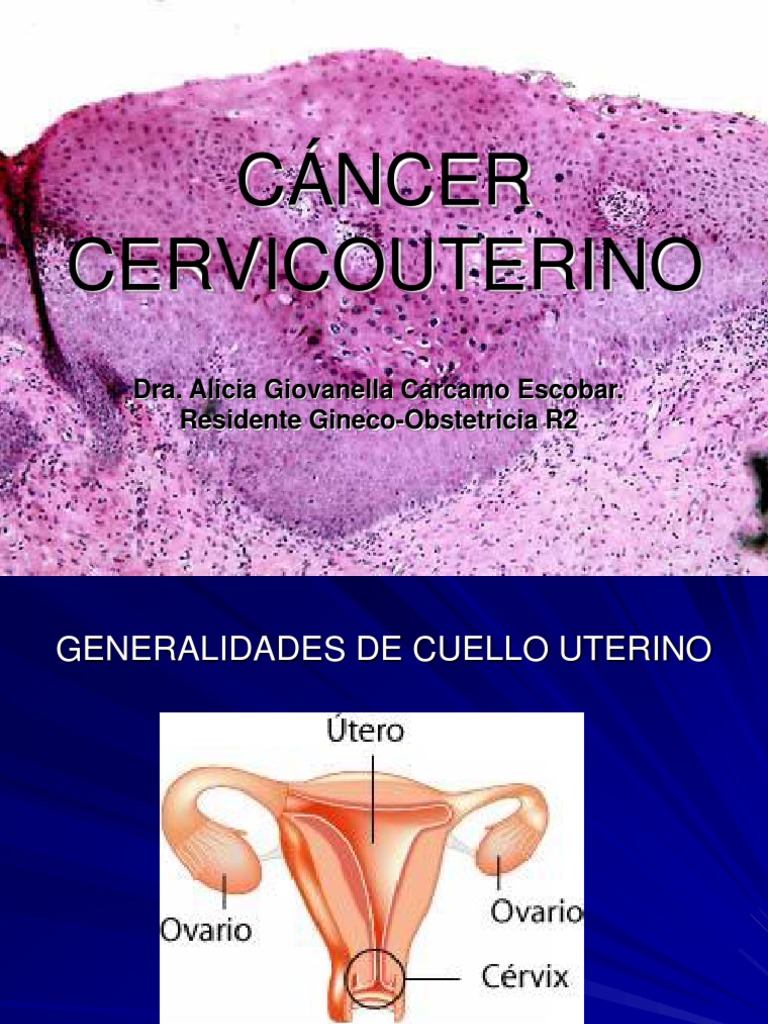 Cancer Cervicouterino | Cáncer de cuello uterino | Medicina