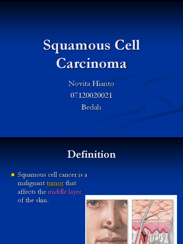 An Overview of Squamous Cell Carcinoma: Causes, Symptoms, Treatment ...
