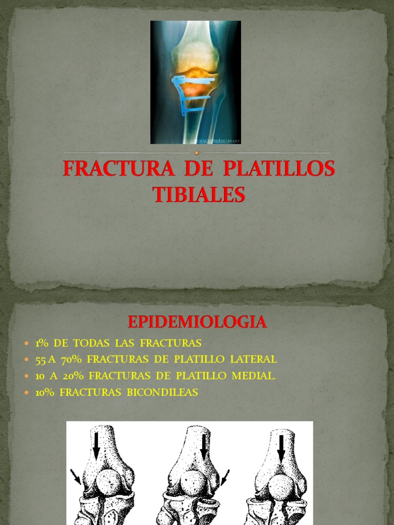 FX de Platillos Tibiales | PDF | Lesión | Rodilla