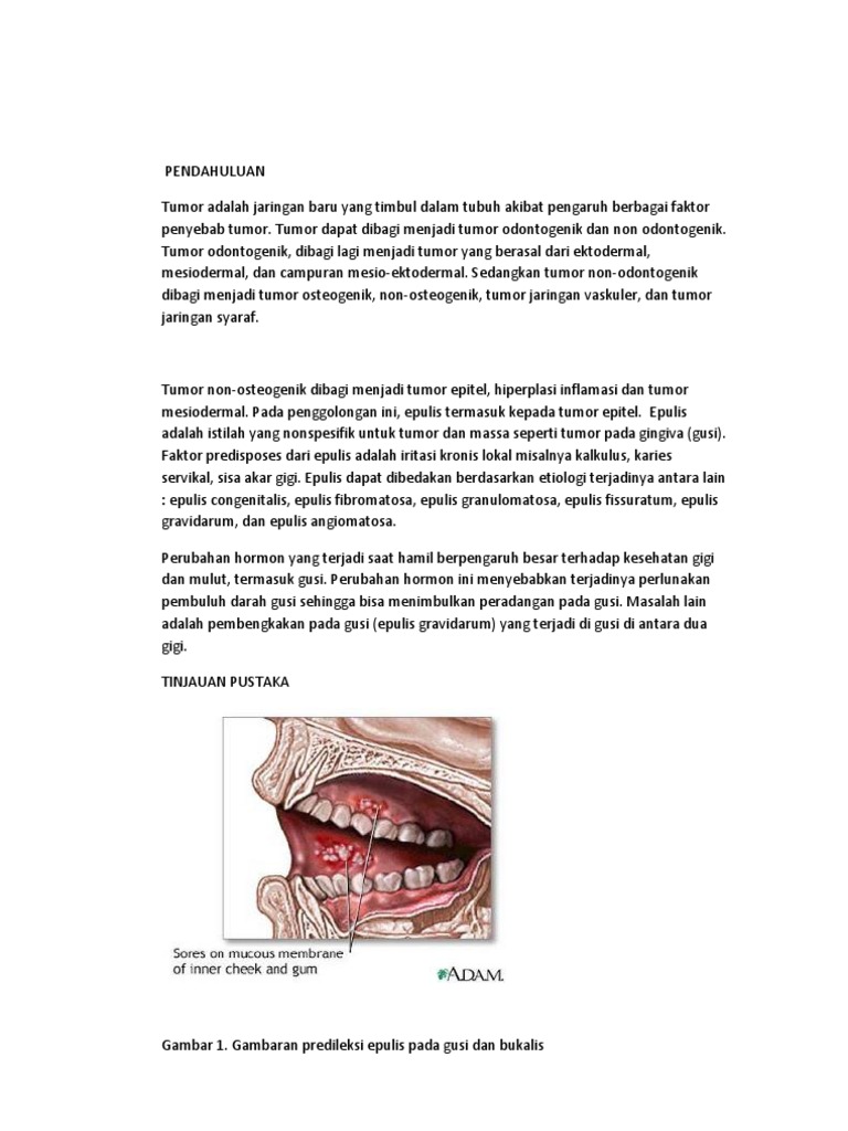 Epulis | PDF