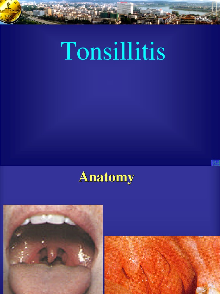 Tonsillitis Jpk Gxmu Edu Cn | Epidemiology | Public Health
