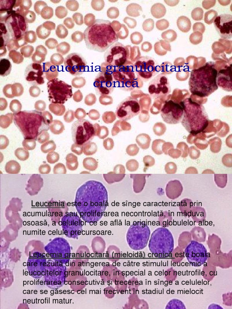 Leucemia .ppt