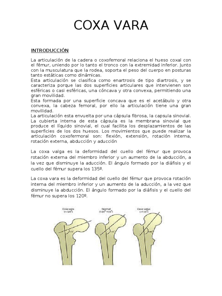 Coxa Vara | PDF | Cadera | Sistema musculoesquelético