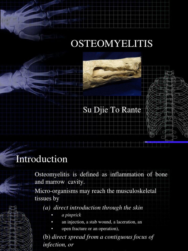 Osteomyelitis | Infection | Public Health