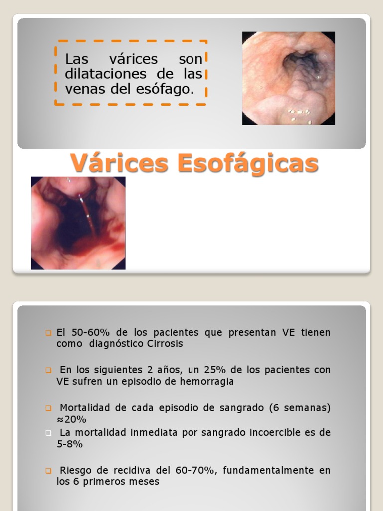 Várices Esofágicas | PDF | Especialidades Medicas | Medicina CLINICA