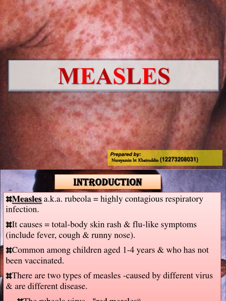 Measles | Measles | Virology | Free 30-day Trial | Scribd