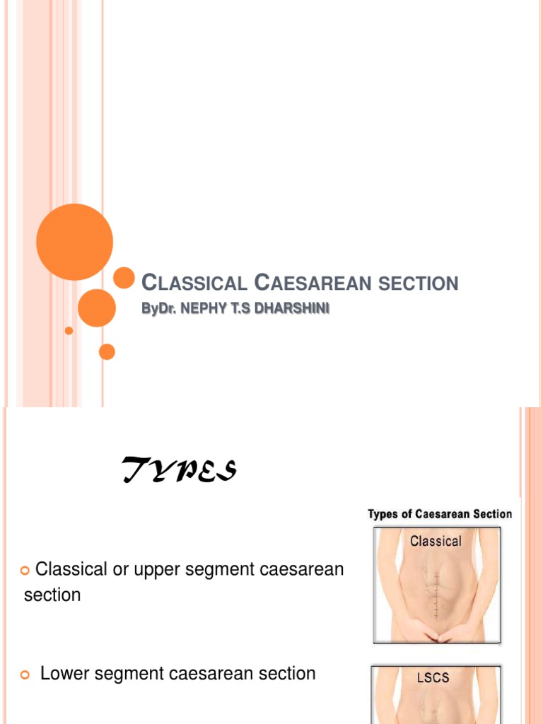 Classical Caesarean Section Types | PDF