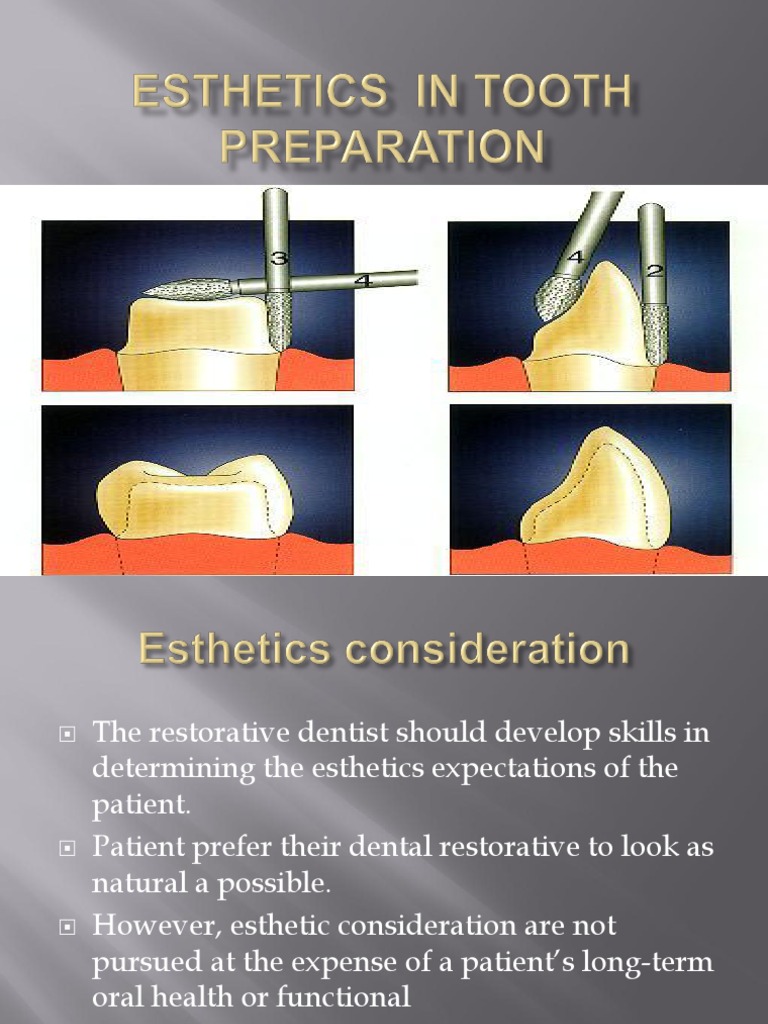 Esthetics in Tooth Preparation | Dentistry Branches | Mouth