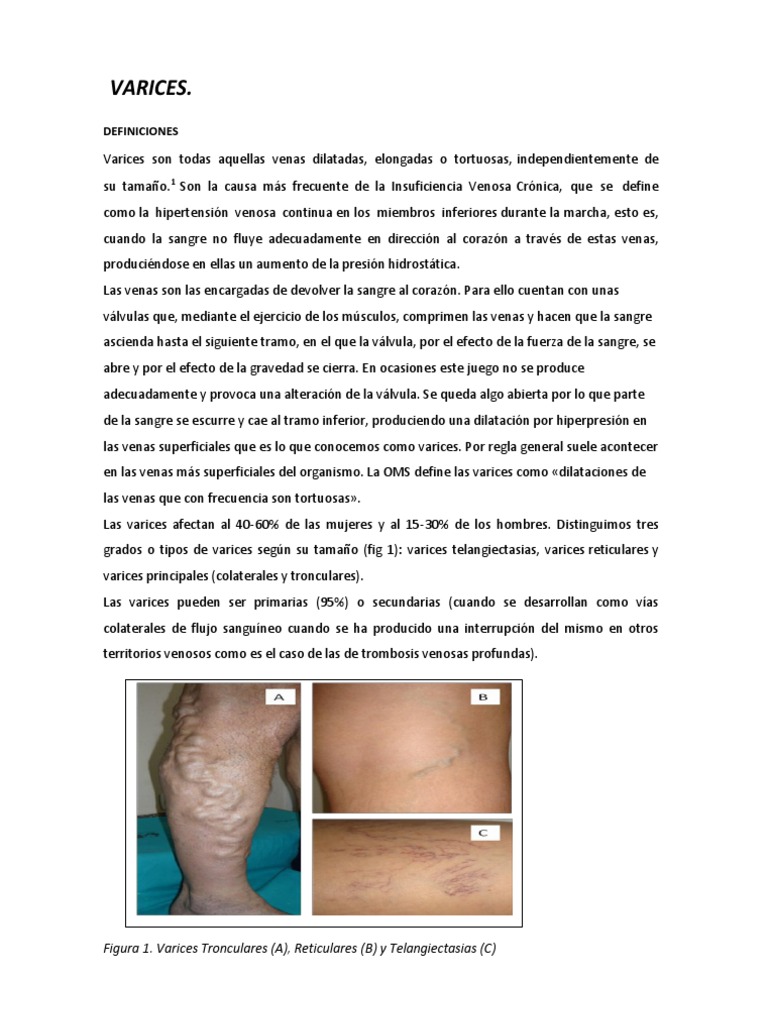 VARICES.docx | Várices | Pierna humana