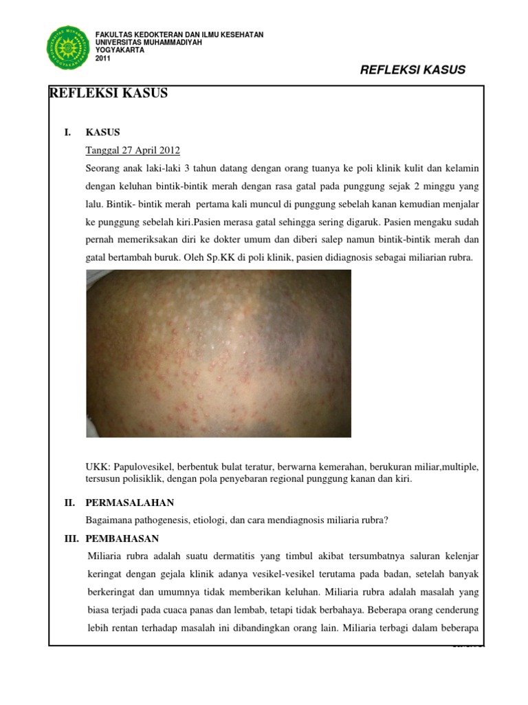 Miliaria Rubra | PDF