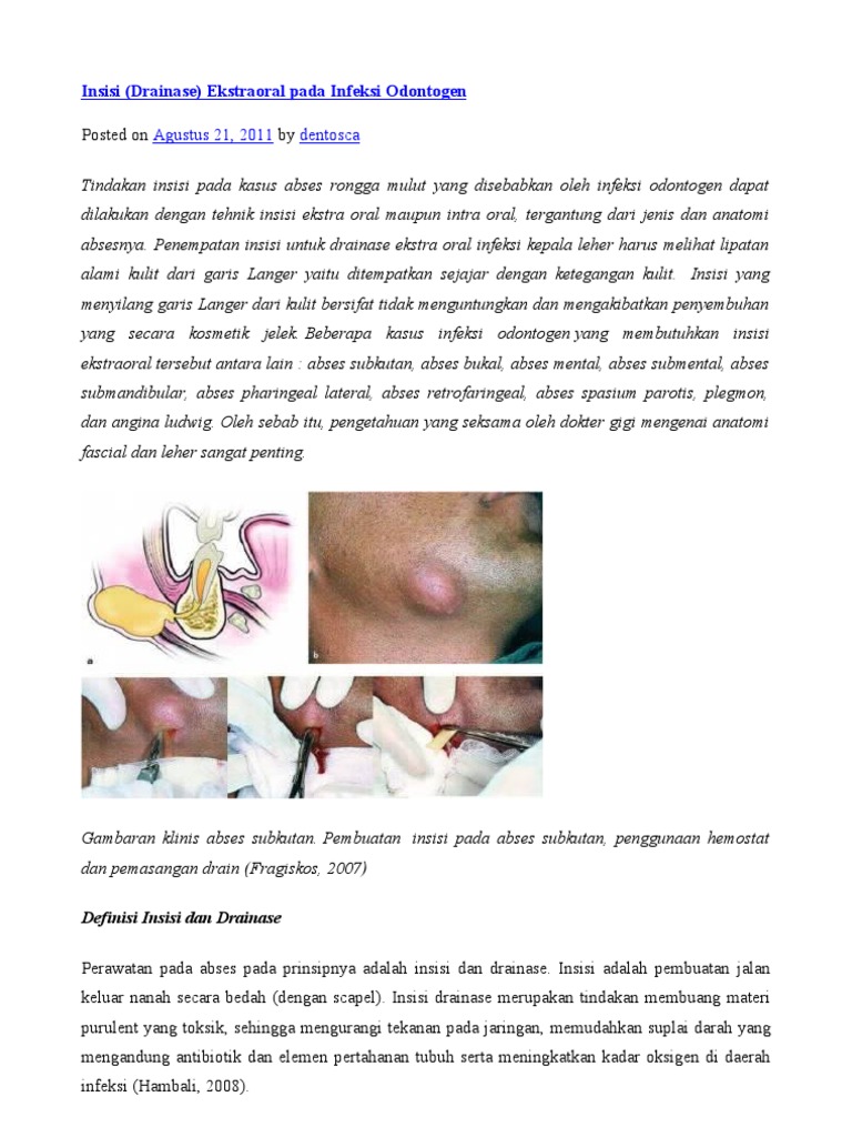 Seminar Insisi Drainase | PDF