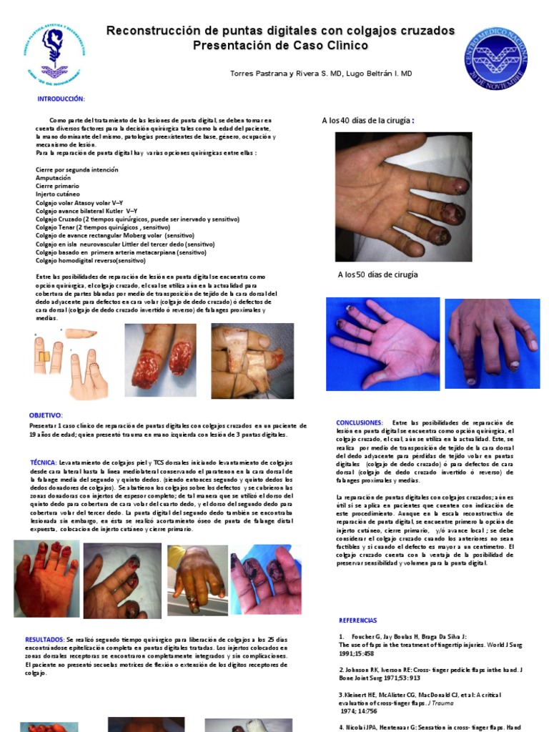 Cartel Cross Finger Flap | Mano | Medicina