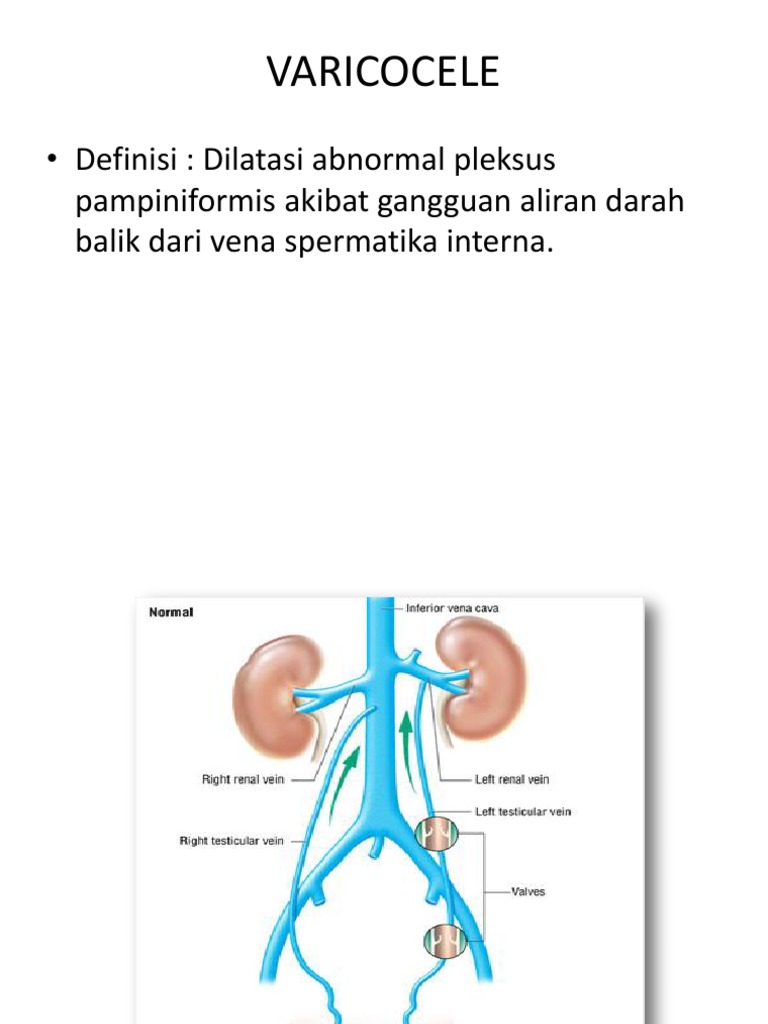 Varicocele | PDF