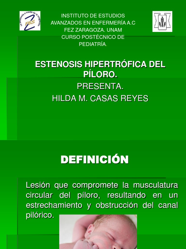 ESTENOSIS HIPERTROFICA DEL PÍLORO. | Estómago | Especialidades Medicas