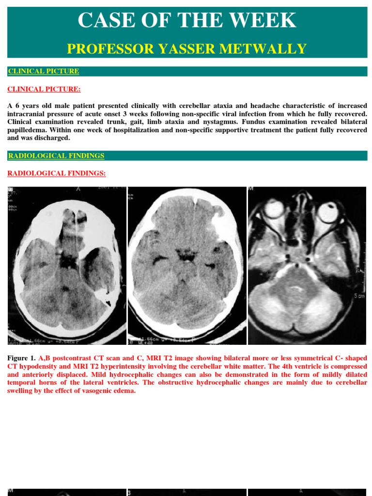 6M Case Report Postinfectious Cerebellitis | PDF | White Matter | Myelin
