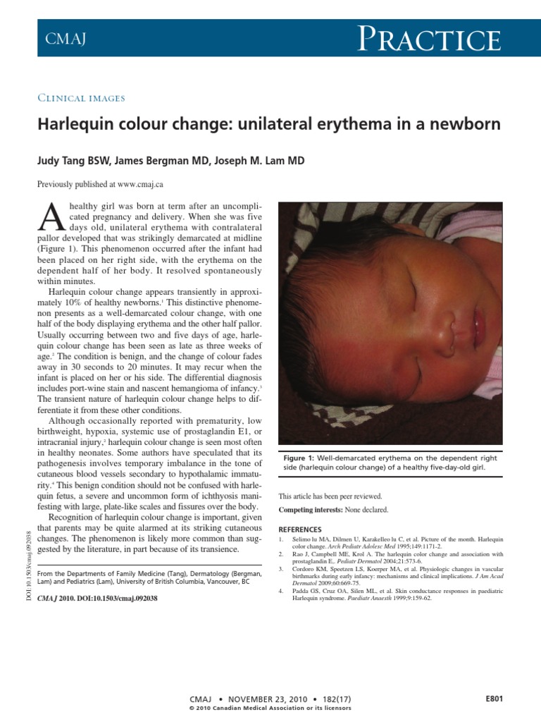 Practice: Harlequin Colour Change: Unilateral Erythema in A Newborn ...