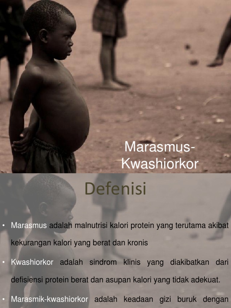 Marasmus kwashiorkor