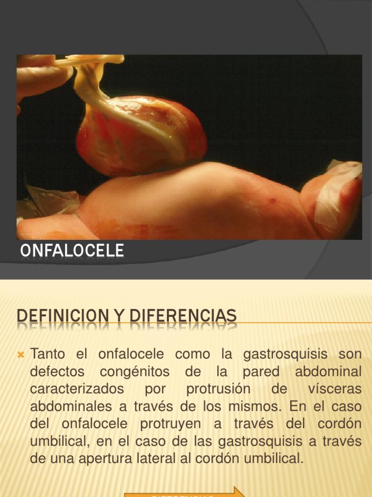Onfalocele 12 de Junio Seminario Embriologia | PDF | Enfermedades y ...