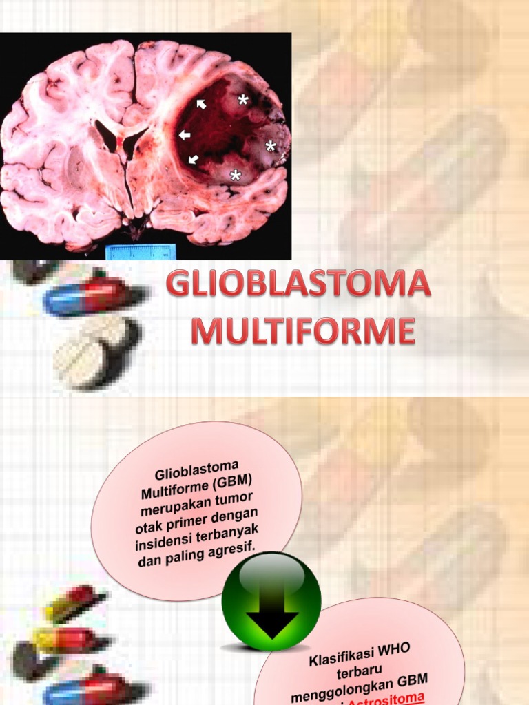 Glioblastoma Multiforme | PDF