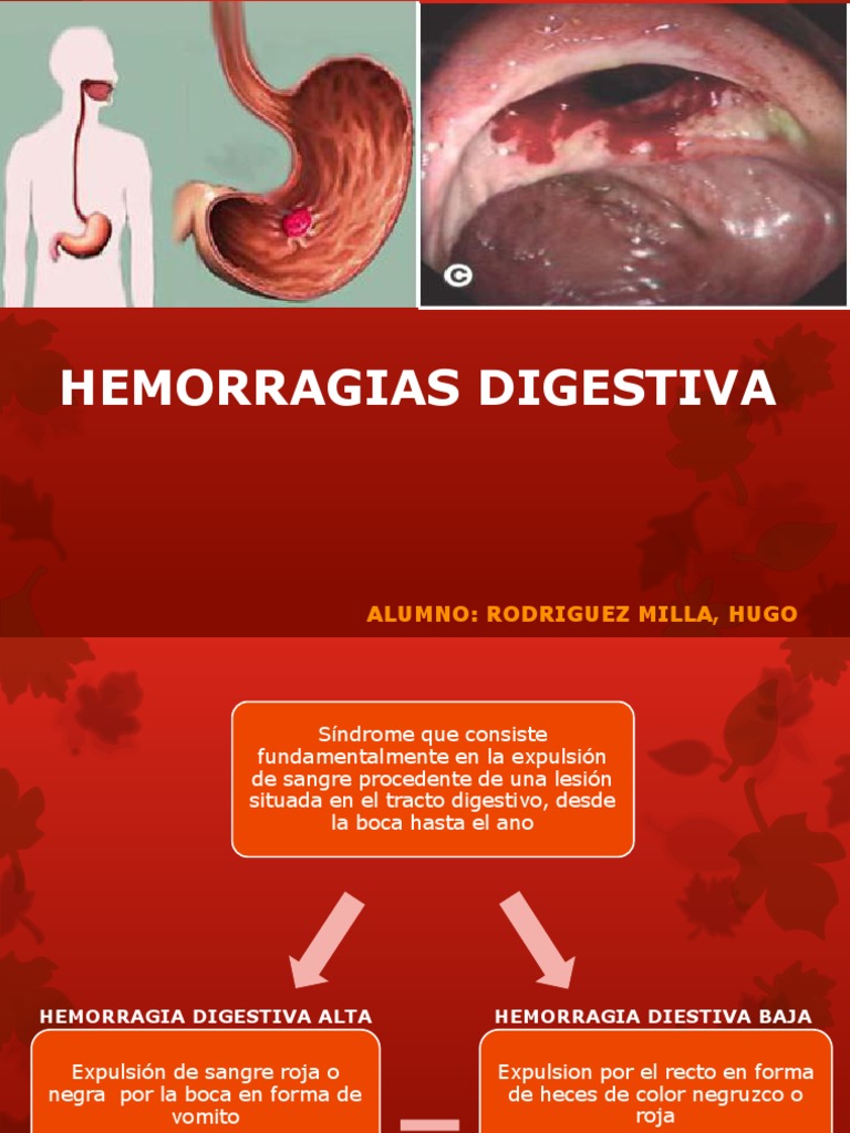 Hemorragias Digestiva | PDF