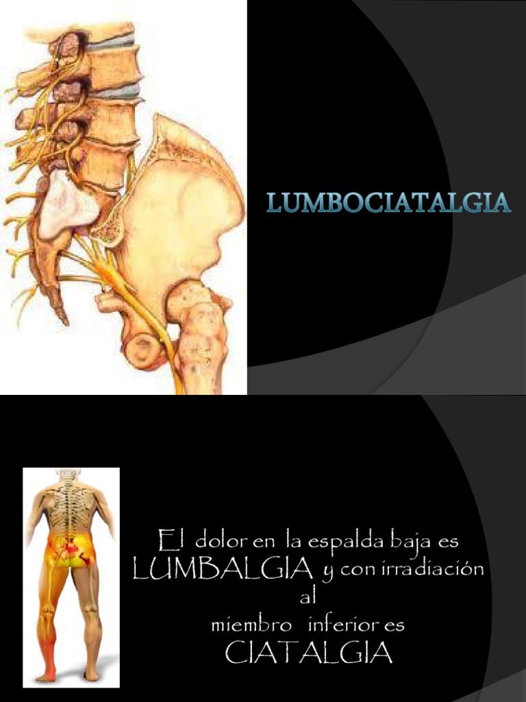 Lumbociatalgia Expo | PDF | Dolor lumbar | Enfermedades y trastornos
