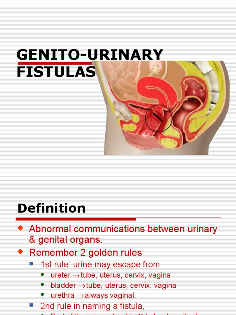 Genito-Urinary Fistula | PDF | Vagina | Urinary Bladder Genito-Urinary Fistula | PDF | Vagina | Urinary Bladder