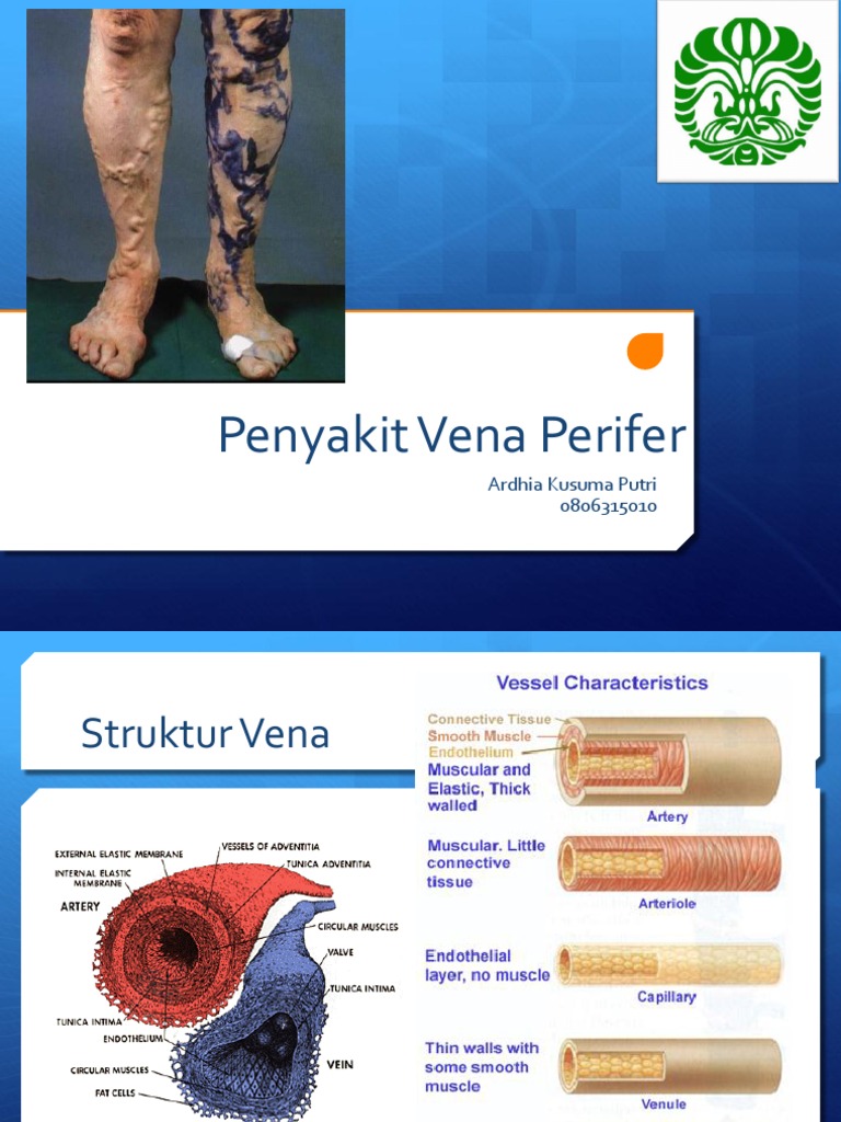 Penyakit Vena Perifer | PDF