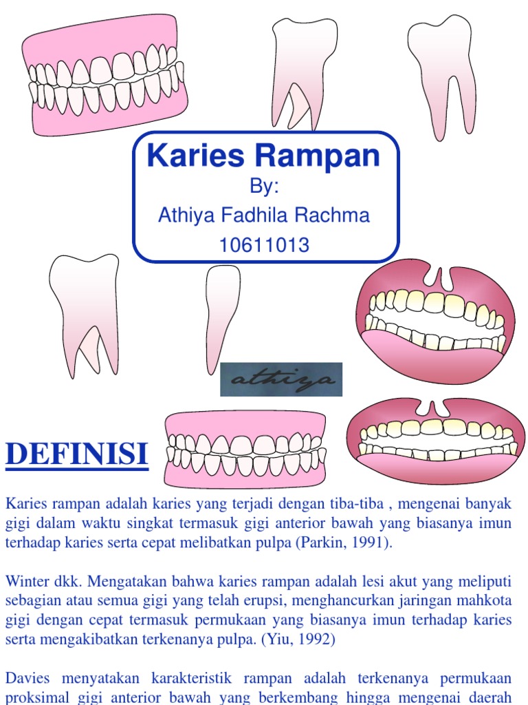 rampan karies ppt