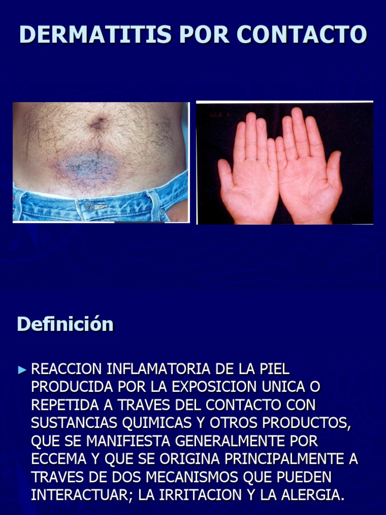 Mecanismo De La Dermatitis Alérgica De Contacto
