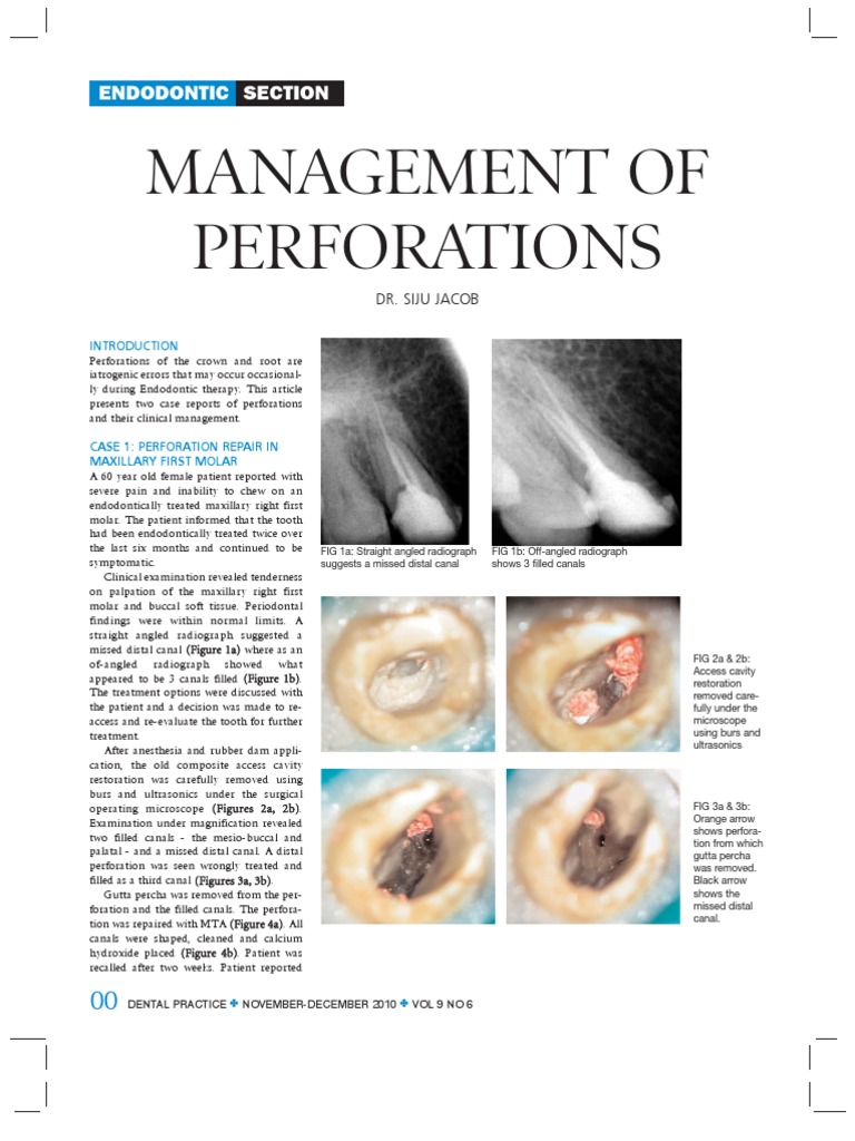 Perforation Repair | PDF | Dentistry | Dentistry Branches