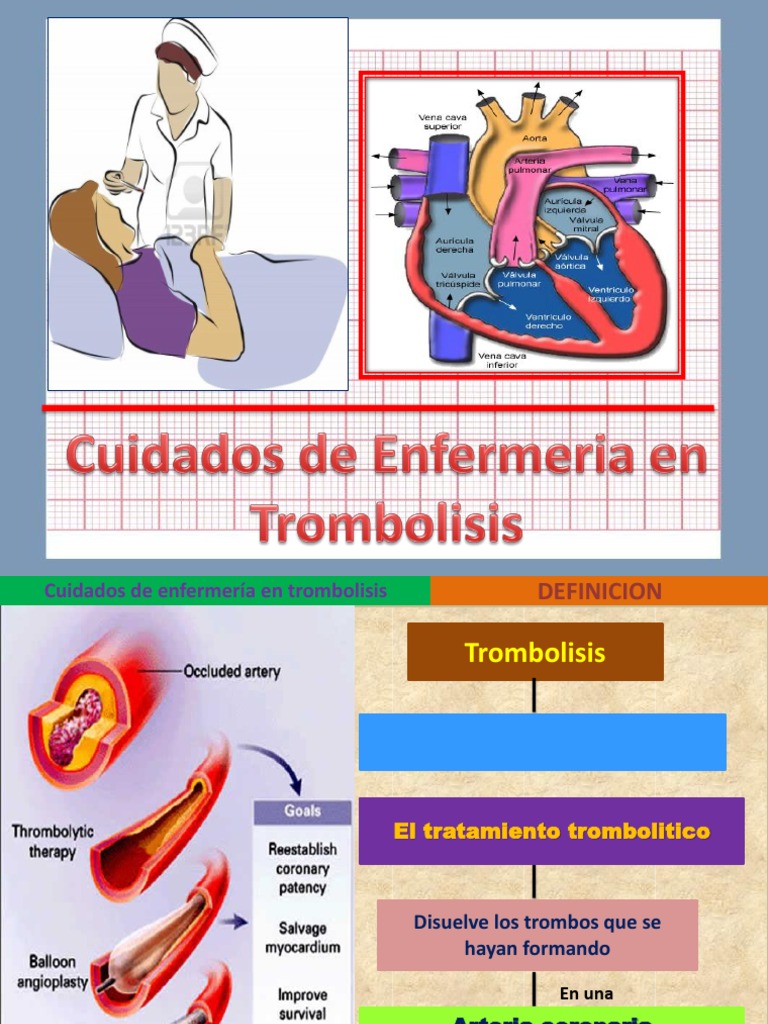 Cuidados de Enfermería en Trombolisis | PDF | Arritmia cardiaca | Isquemia