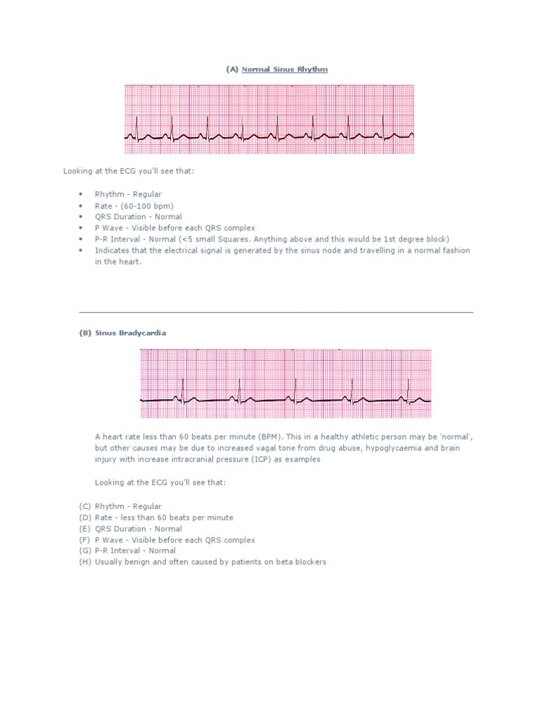 An Analysis of Common Cardiac Rhythms and Abnormalities as Depicted on ...