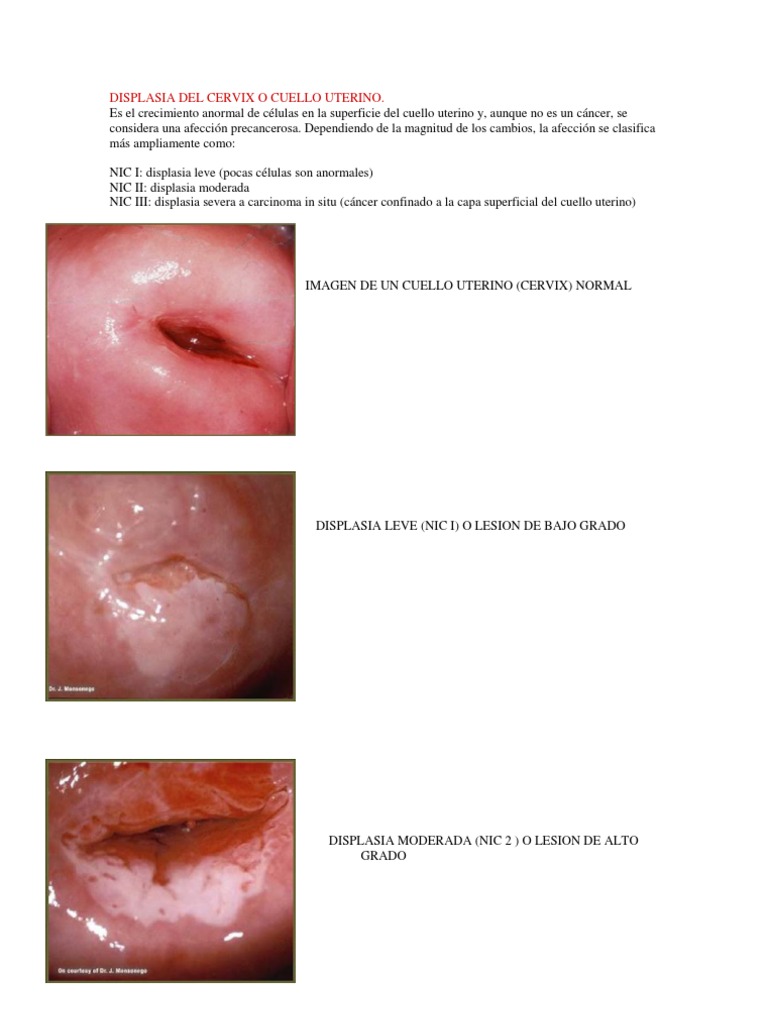 Displasia Del Cervix o Cuello Uterino | PDF | Câncer cervical | Remédio
