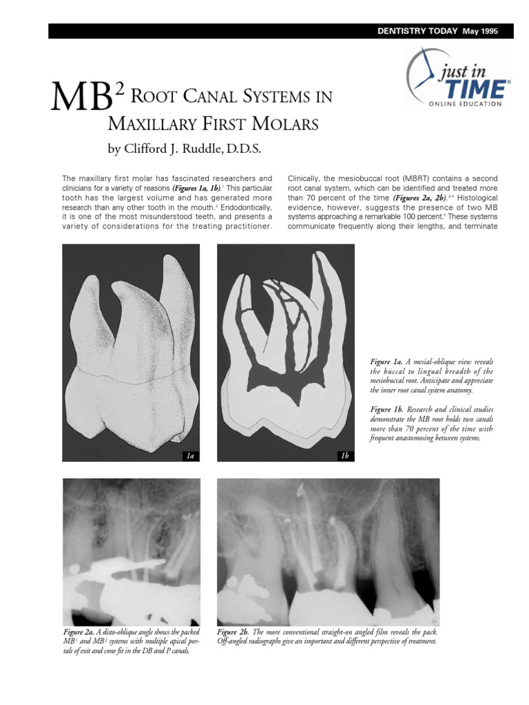 MB2 Canal Systems in Maxillary Molars | PDF