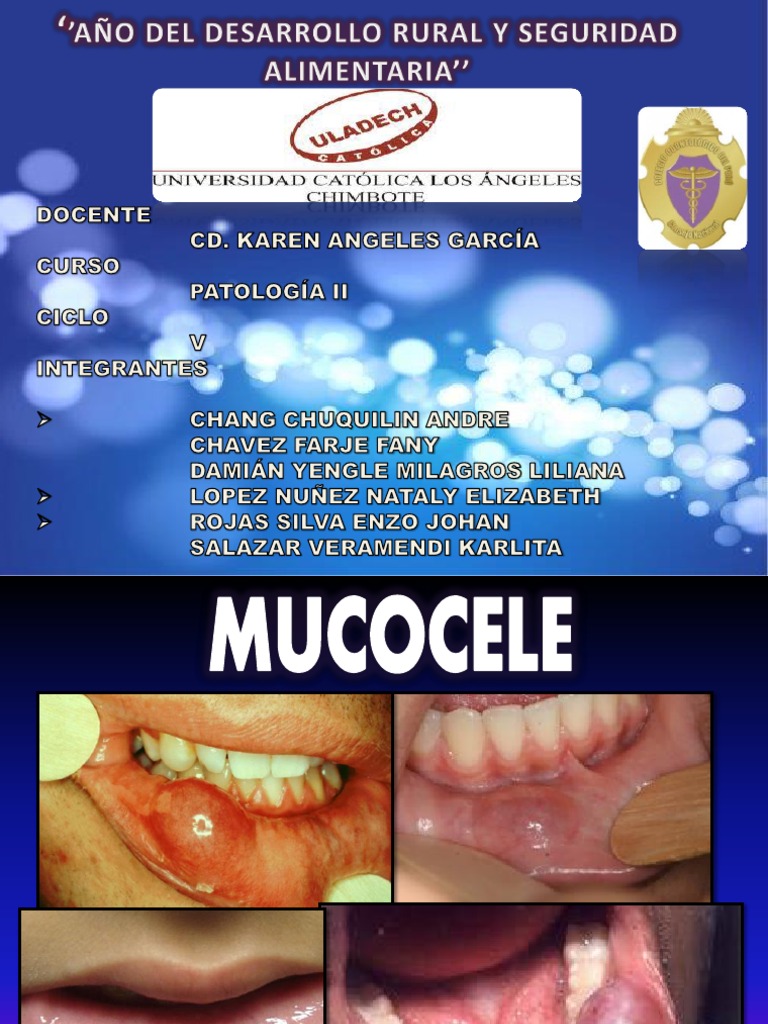 Mucocele Expo | PDF | Anatomía | Medicina