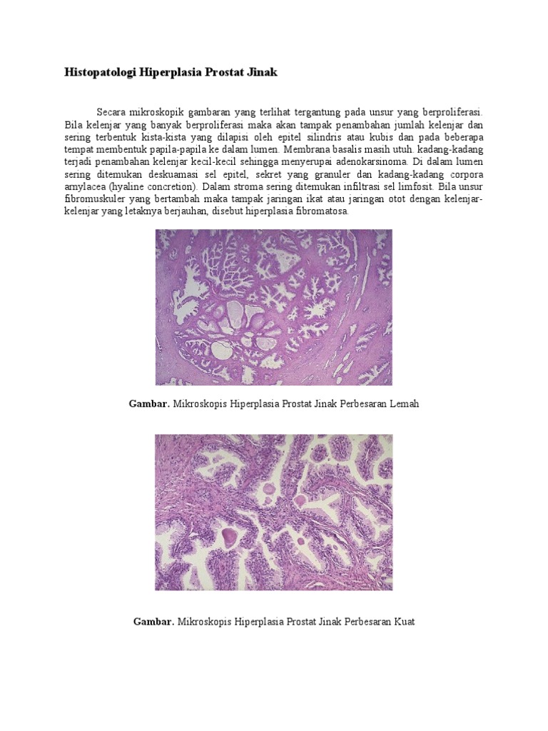 Histopatologi Hiperplasia Prostat Jinak Dan CCS | PDF