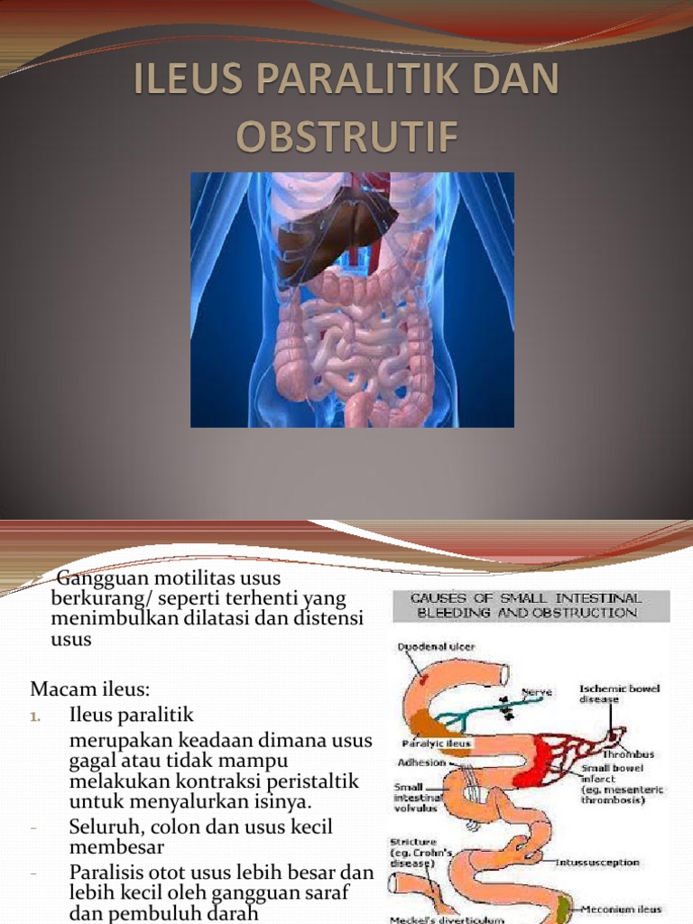 Ileus Paralitik Dan Obstrutif | PDF