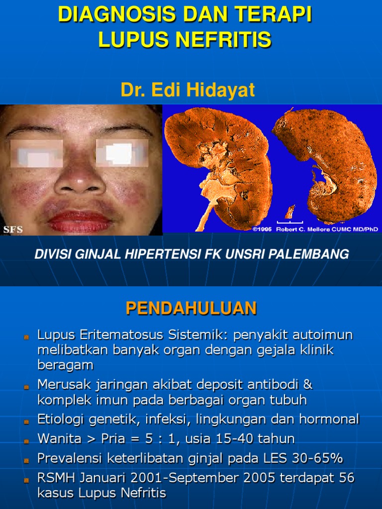Tatalaksana Lupus Nefritis, Dr. Edi Hidayat | PDF