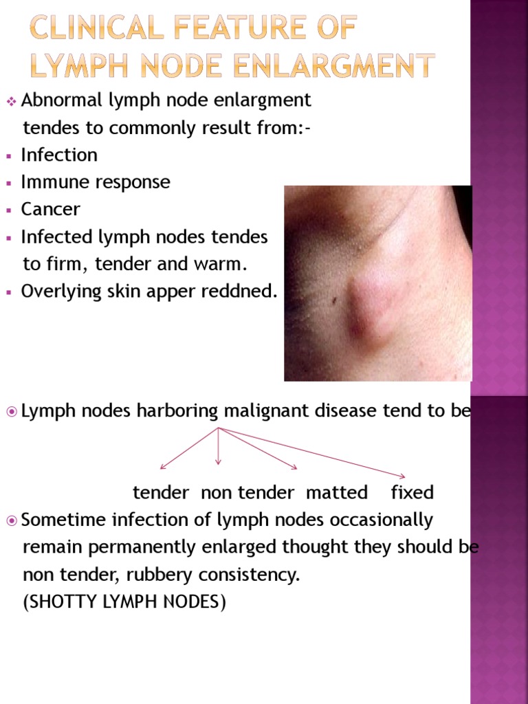 Understanding Lymph Node Consistency | PDF | Neck | Lymph Node