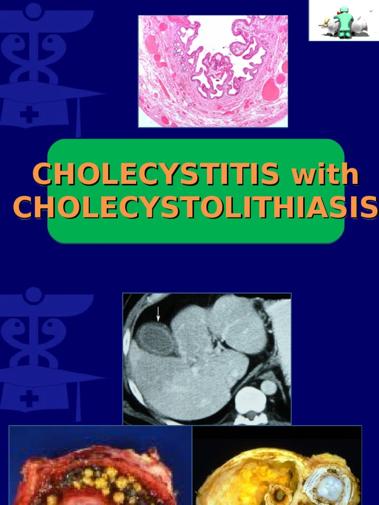 Cholecystitis With Cholecystolithiasis | PDF | Gallbladder | Bile