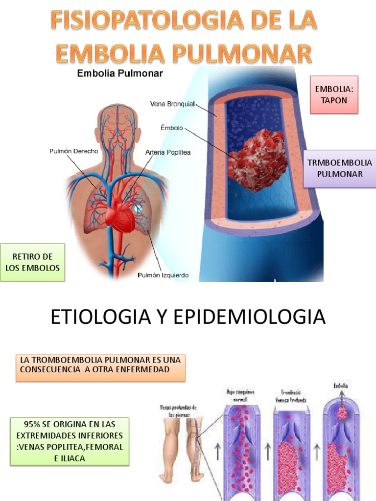 Embolia Pulmonar | PDF