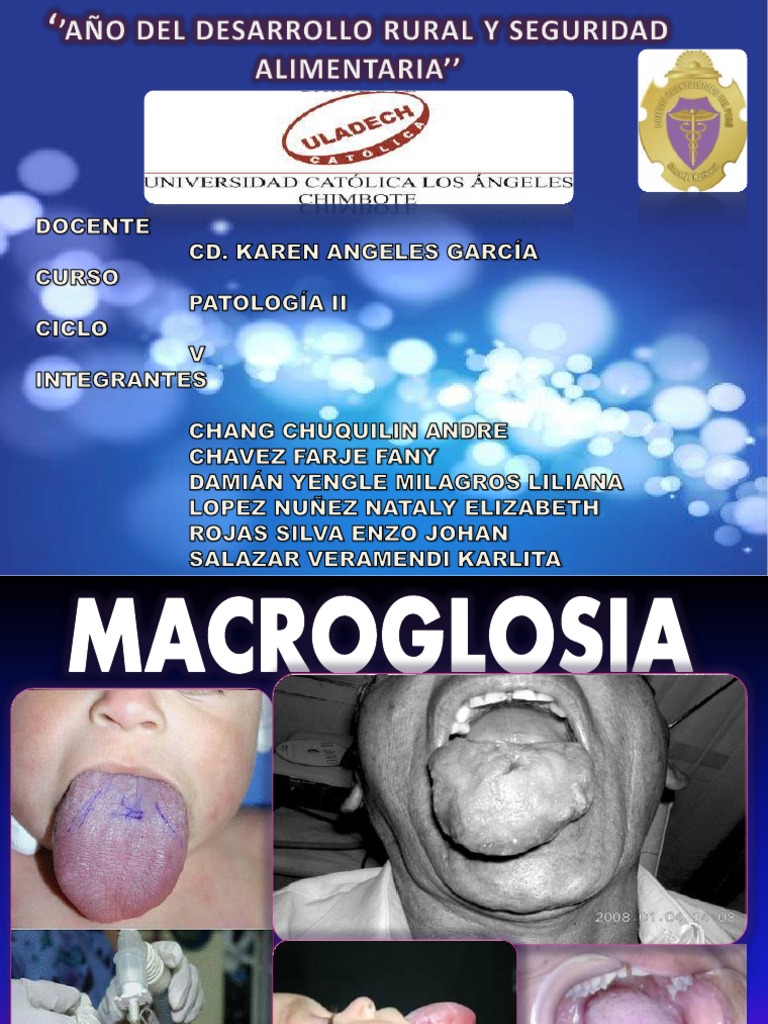 Macroglosia: Causas y Manejo Integral | PDF | Ortodoncia | Cirugía