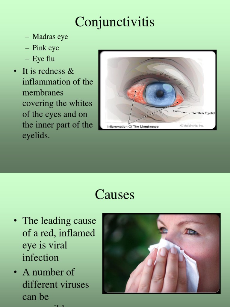 Conjunctivitis | PDF