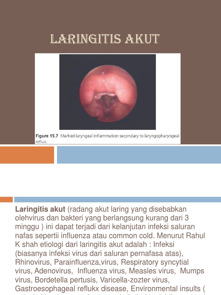 Laringitis Akut | PDF