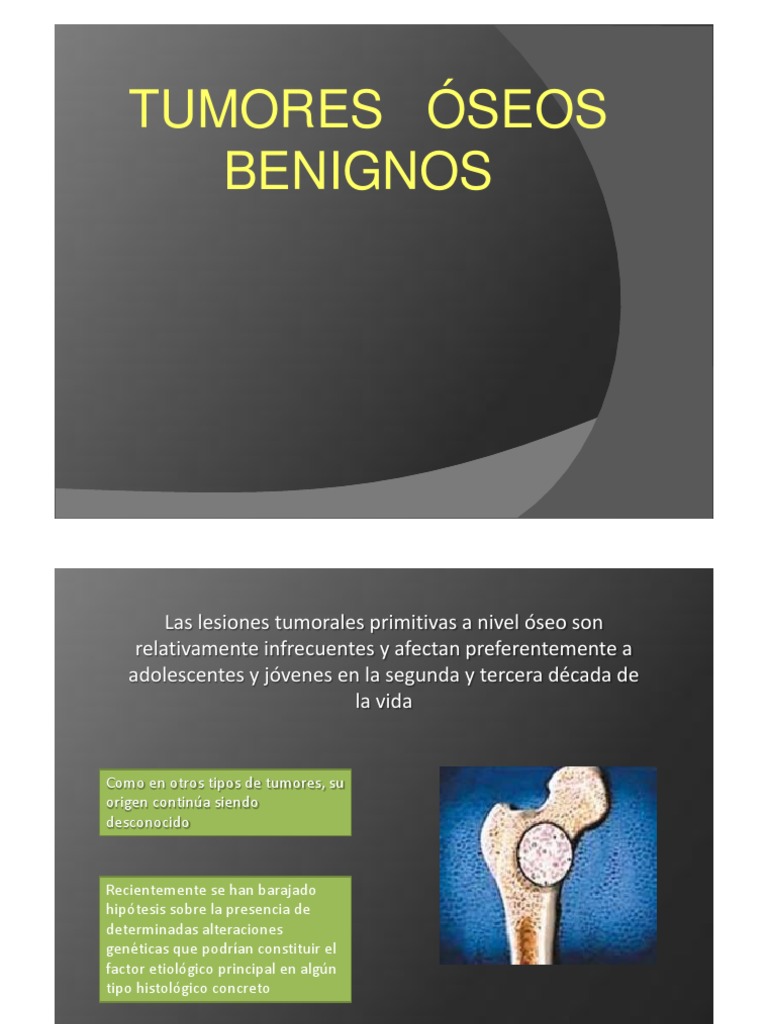 Tumores Oseos Benignos Richad | PDF | Hueso | Cáncer