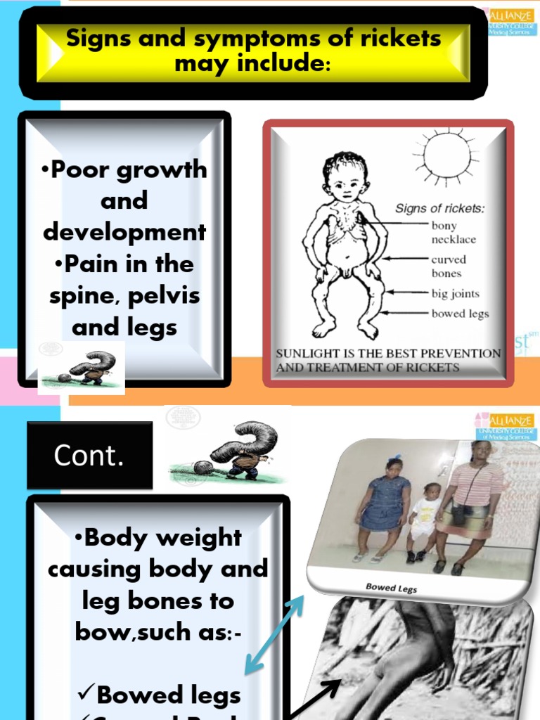 Signs and Symptoms of Rickets May Include:: - Poor Growth | PDF ...