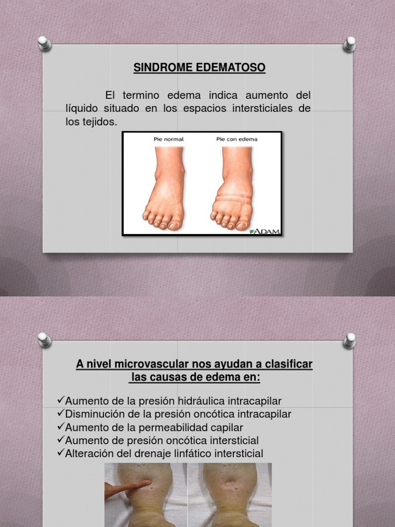 Clasificación del Síndrome Edematoso | PDF | Edema | Enfermedades y ...