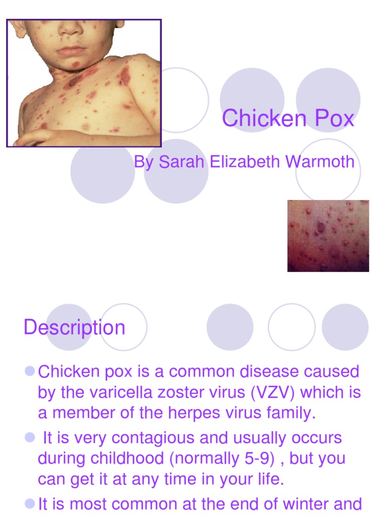 Chicken Pox: by Sarah Elizabeth Warmoth | PDF | Viral Diseases ...